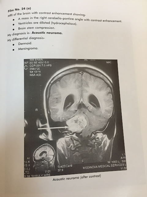 CT SCAN OF BRAIN-12