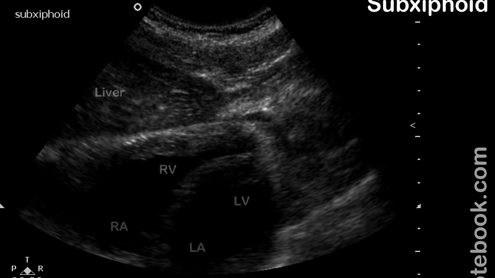 Echocardiogram Congestive Heart Failure - Hear Choices