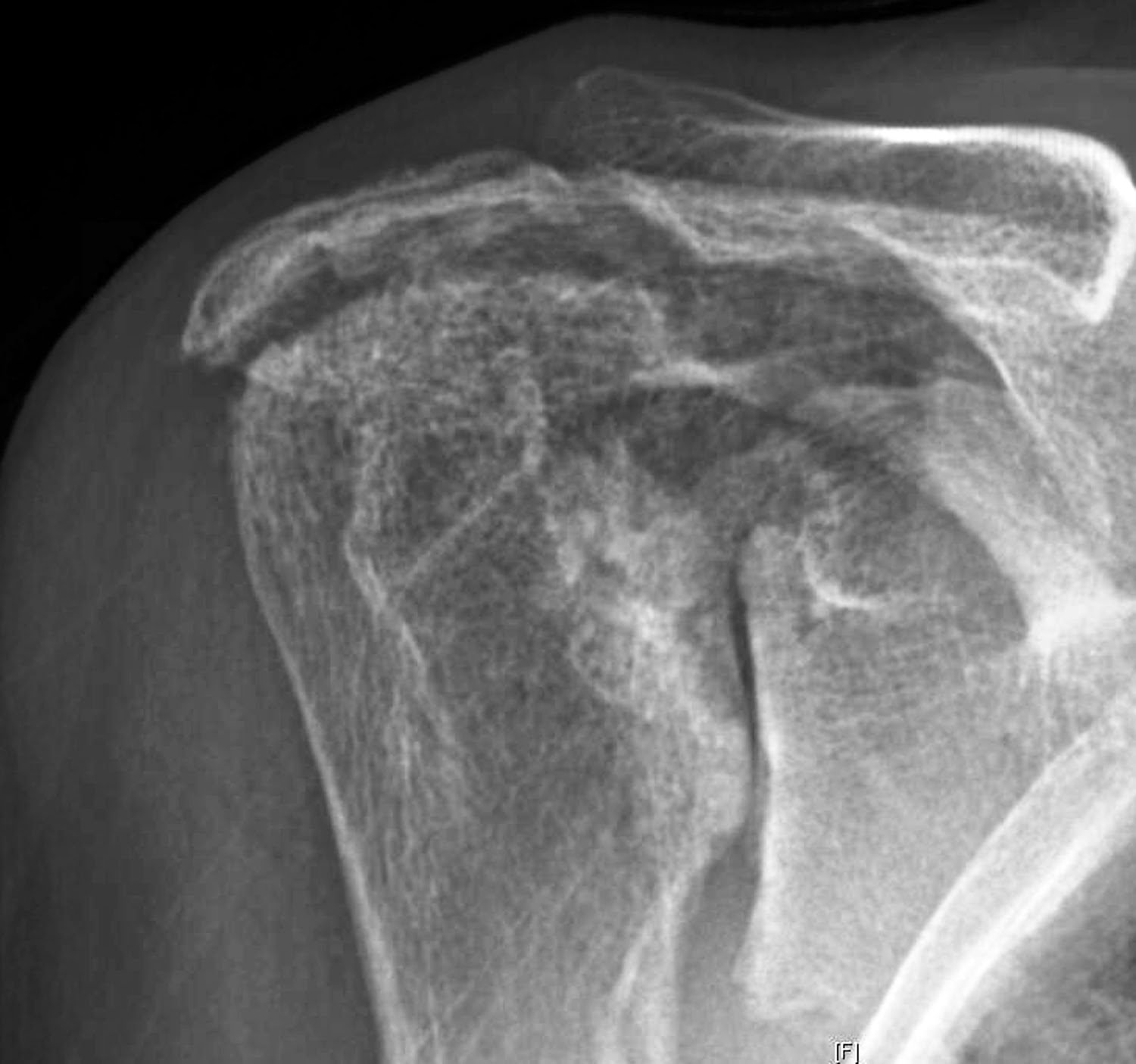 UW Shoulder and Elbow Academy: Shoulder joint replacement - many ...