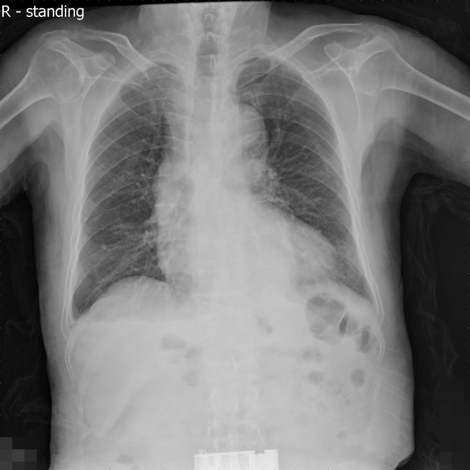 CXR 胸部x光判讀 main carina tumor