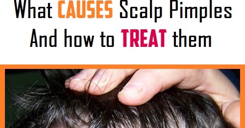 Scalp Pimples What Causes Them And How To Treat Them How To Beauty