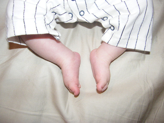Cason's Journey : Sixth Set of Casts & New Horton Click Bar/Brace