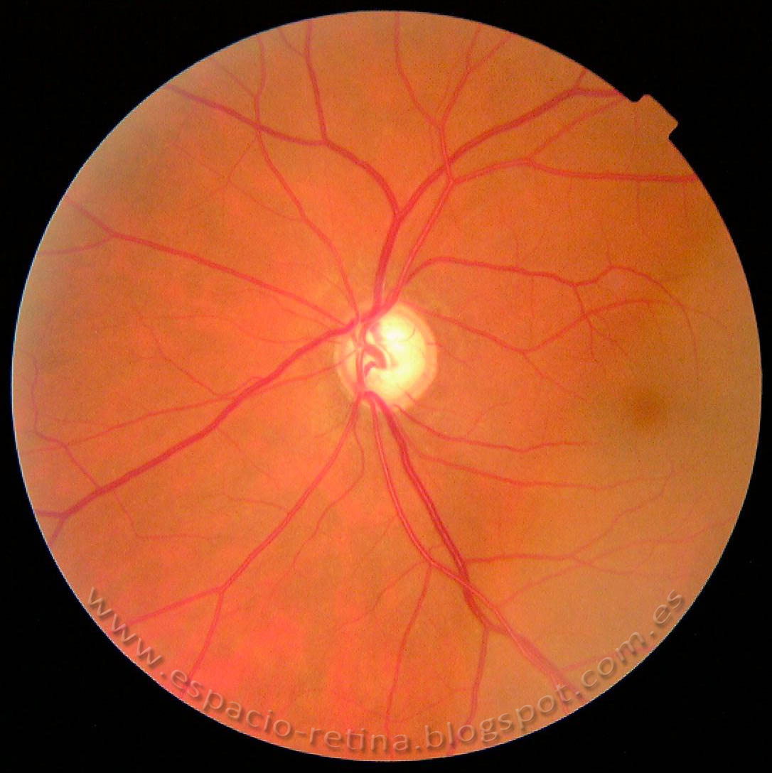 ESPACIO RETINA: Papila excavada.
