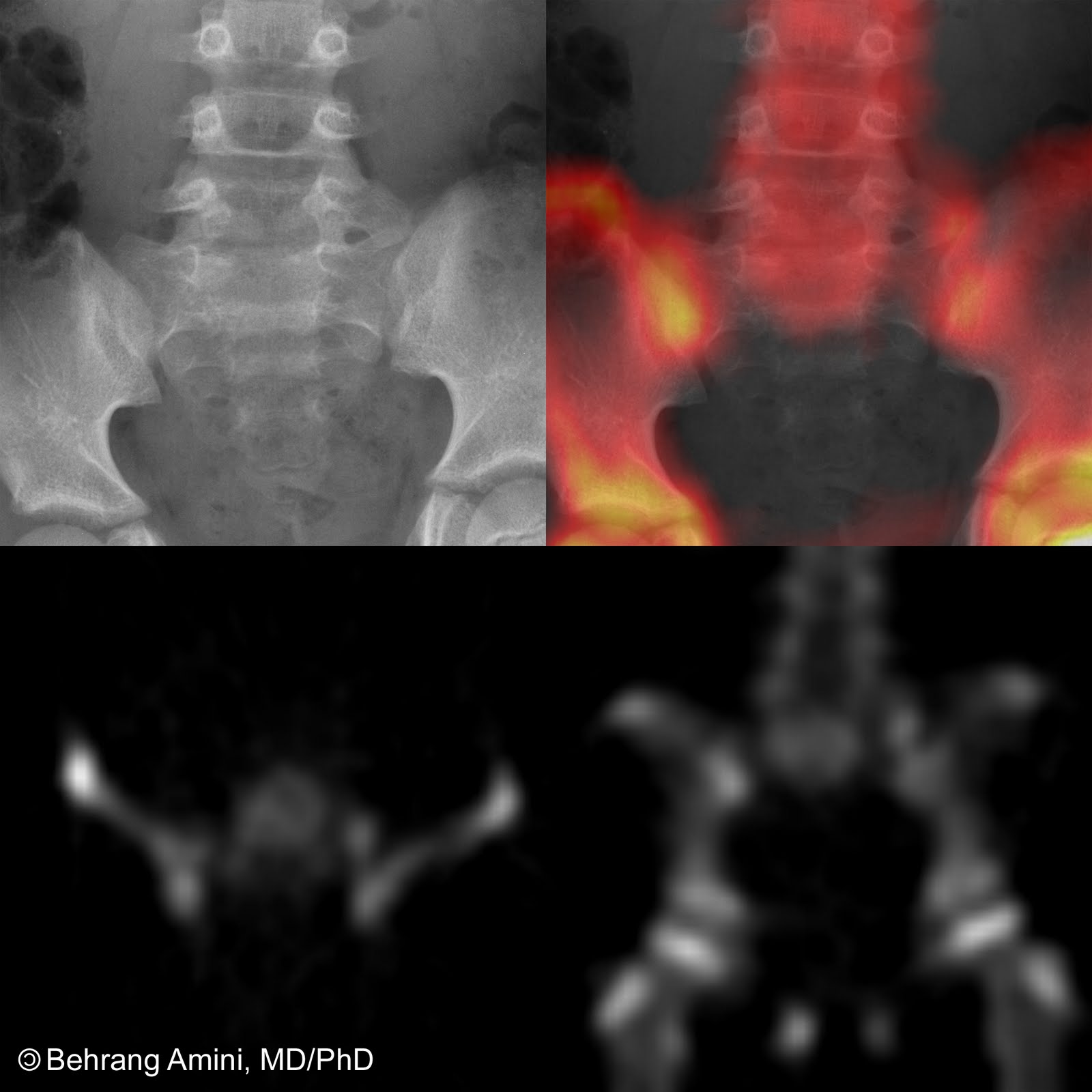 Roentgen Ray Reader: Bertolotti Syndrome