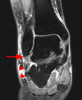MRI Musculo-Skeletal Section: Lateral hindfoot impingement.