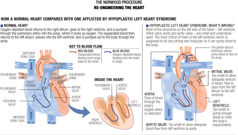 LIFE with HLHS ( hypo-plastic left heart syndrome )