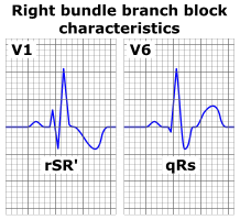ECGs for EMS: Identification of the Right Bundle Branch Block