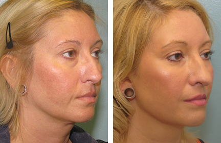 Malay Singapore Times: Get Rid Of Droopy Jowls and Aging Signs with ...