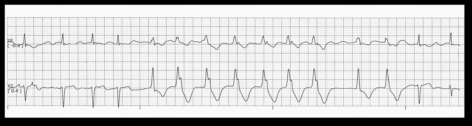 Various Accelerated Idioventricular Rhythms