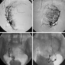 Medical Treatment Pictures-for Better Understanding: Embolization ...