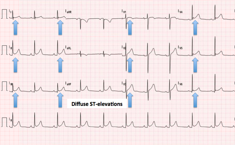 Emergency Medicine Visual Diagnosis: Diagnosis: Acute Pericarditis