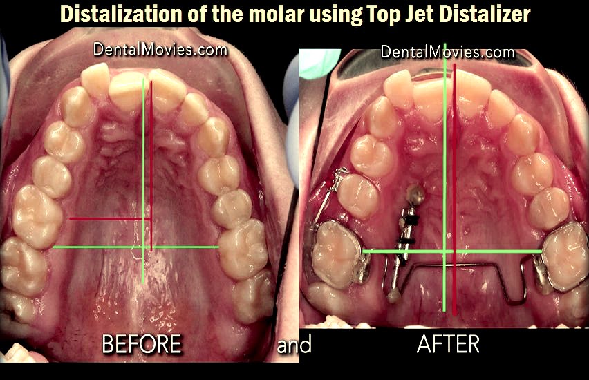 ORTHODONTICS: Distalization of the molar using Top Jet Distalizer ...