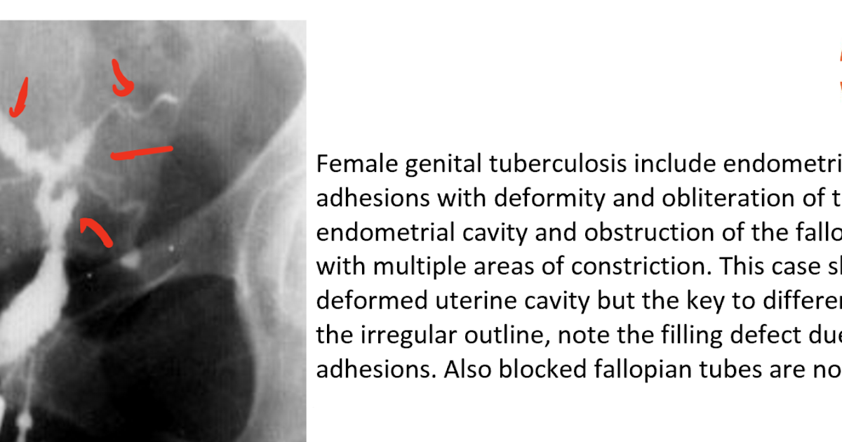 Endometrial Tuberculosis: HSG - Sumer's Radiology Blog