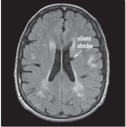 STROKE ISKEMIK - ALL ABOUT NURSING