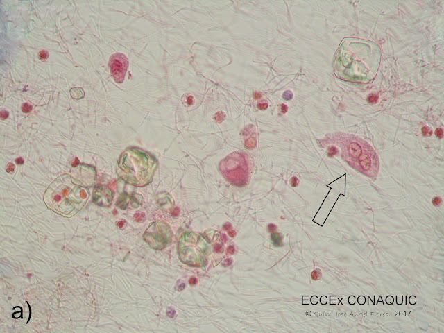 Caso UR-noviembre-17 (Enfoque: uroepitelio)