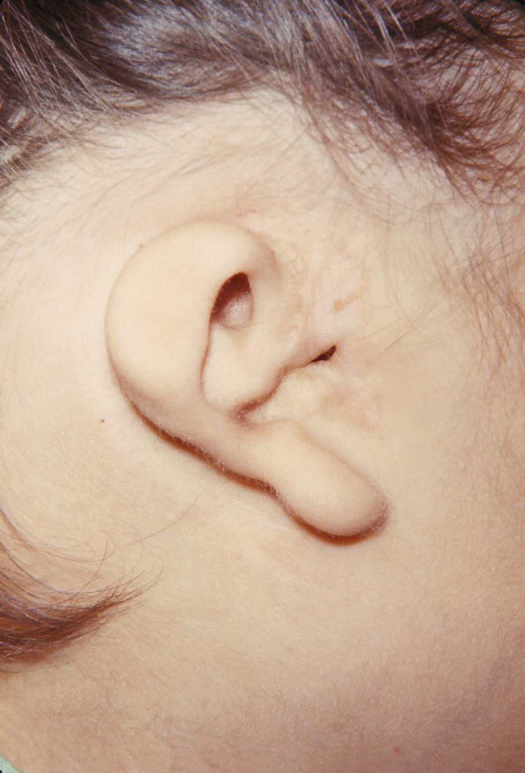 DISEASES OF EXTERNAL EAR.ppt ~ YOUNG DOCTORS' RESEARCH FORUM