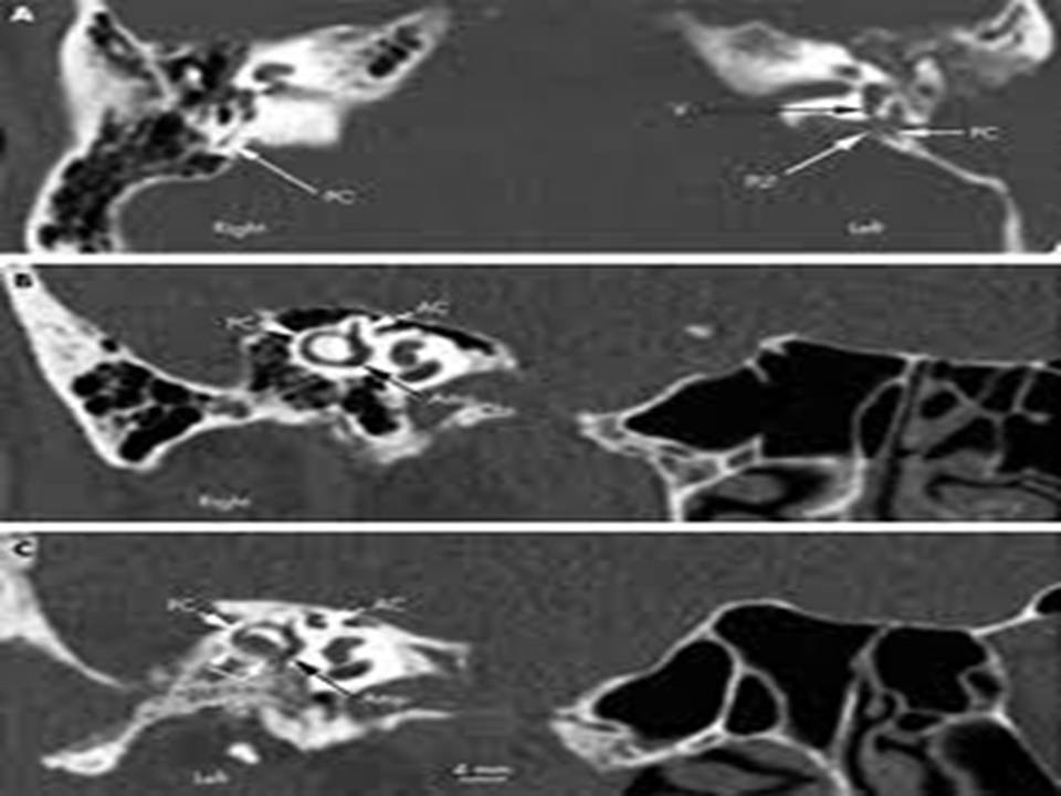 Pyothorax Without Fistula