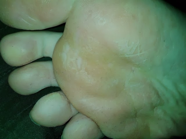 Tulip Lips: Talp betegség: Pitted keratolysis