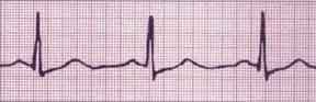 Learning how to read electrocardiograms (EKGs): PQRST an electrical event
