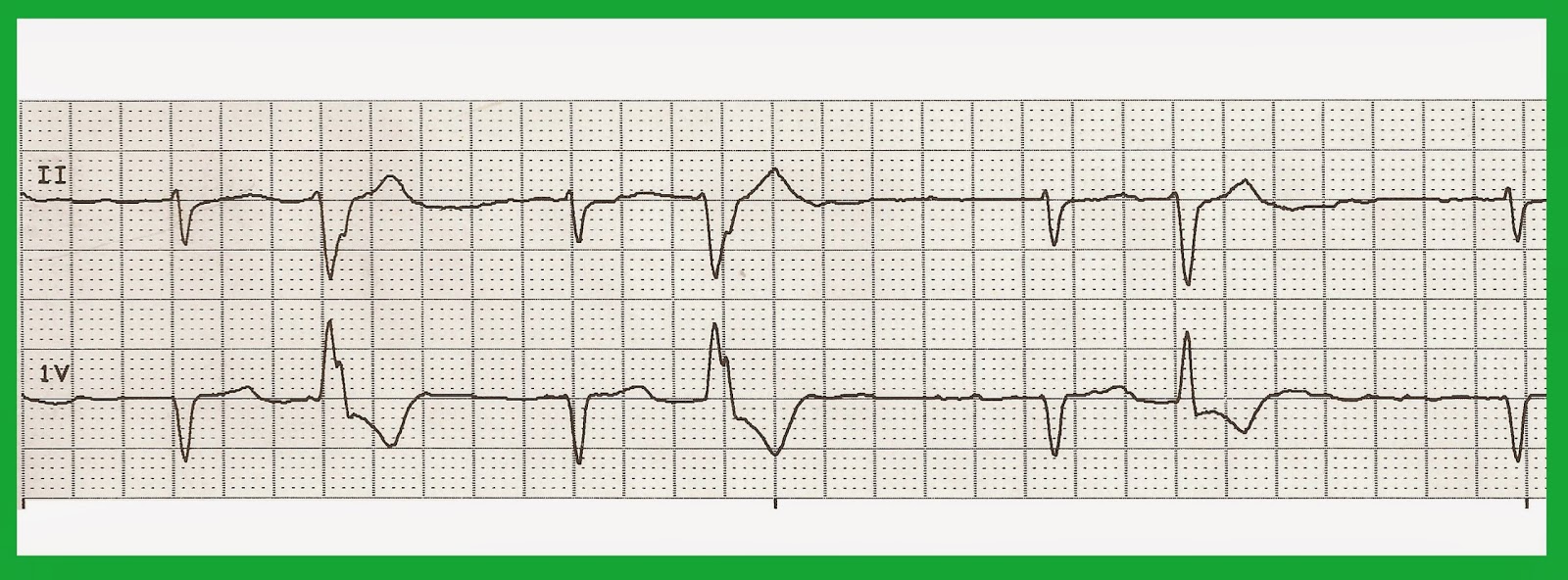 Ventricular Bigeminy