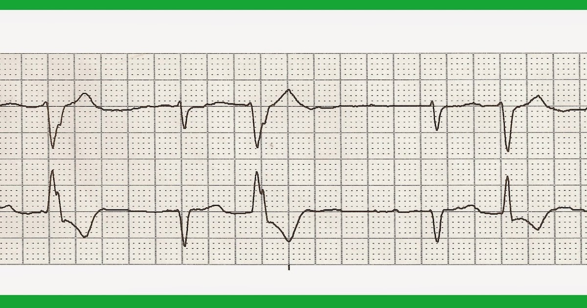 Float Nurse: EKG Rhythm Quiz 263