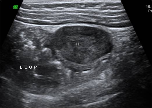 Jejunal Bowel Loop Hematoma: An Ultrasound diagnosis - Sumer's ...