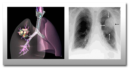 Our extensive findings on the subject of Lung Cancer: History ...