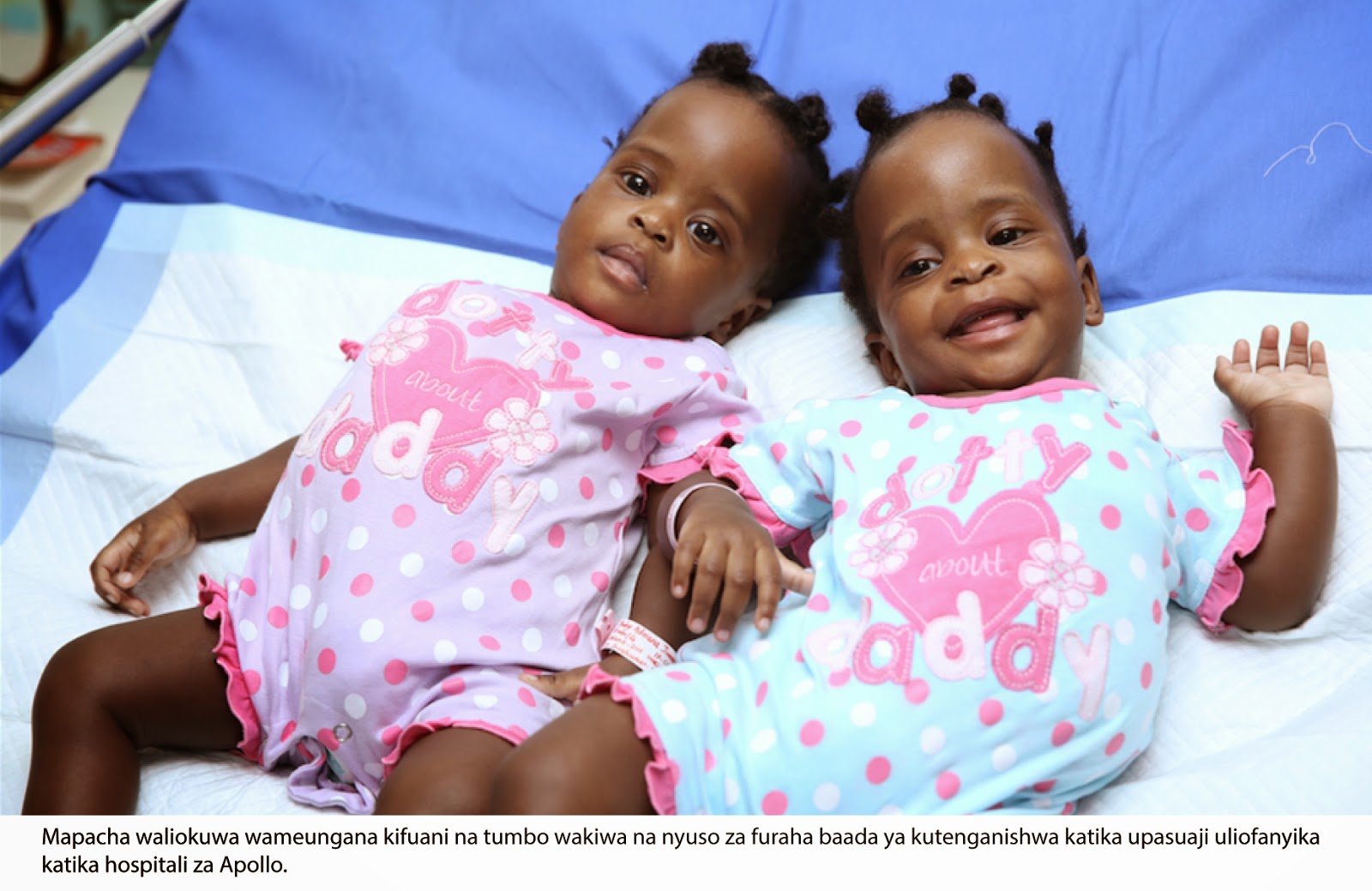 TABORA LEO HABARI: HOSPITALI YA APOLLO YAFANIKIWA KUTENGANISHA MAPACHA ...