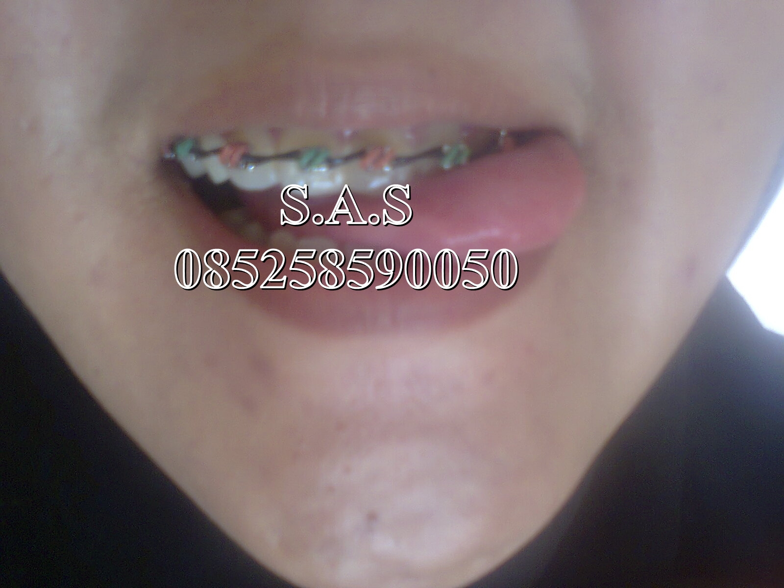 S.A.S - AHLI GIGI KOTA PATI, Jateng & KOTA JEMBER, Jatim: Foto Behel ...