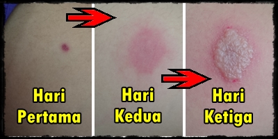 Disyaki Sakit TIBI.... | ~ RIMBA PENUH RAHSIA