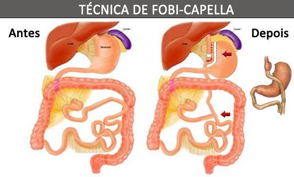 Fobi-Capella: Saiba o que é Fobi-Capella