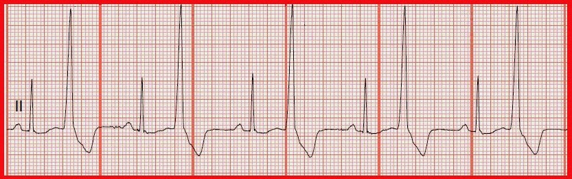 Various Bigeminal PVCs