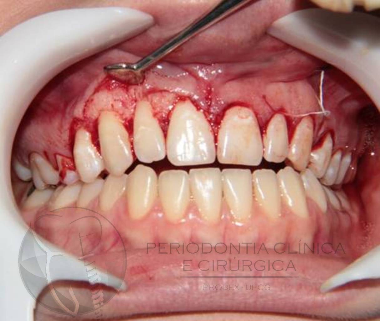 GENGIVECTOMIA EM BISEL INTERNO PARA CORREÇÃO DE SORRISO GENGIVAL