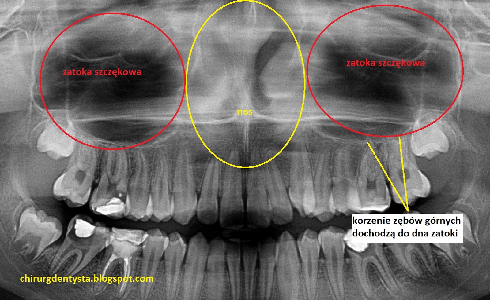 Wojciech Bukowski chirurg dentysta: czerwca 2013