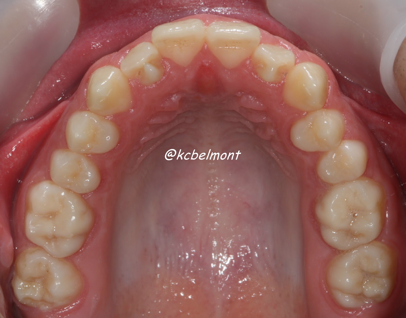 "Te vejo por dentro": Talon Cúspide