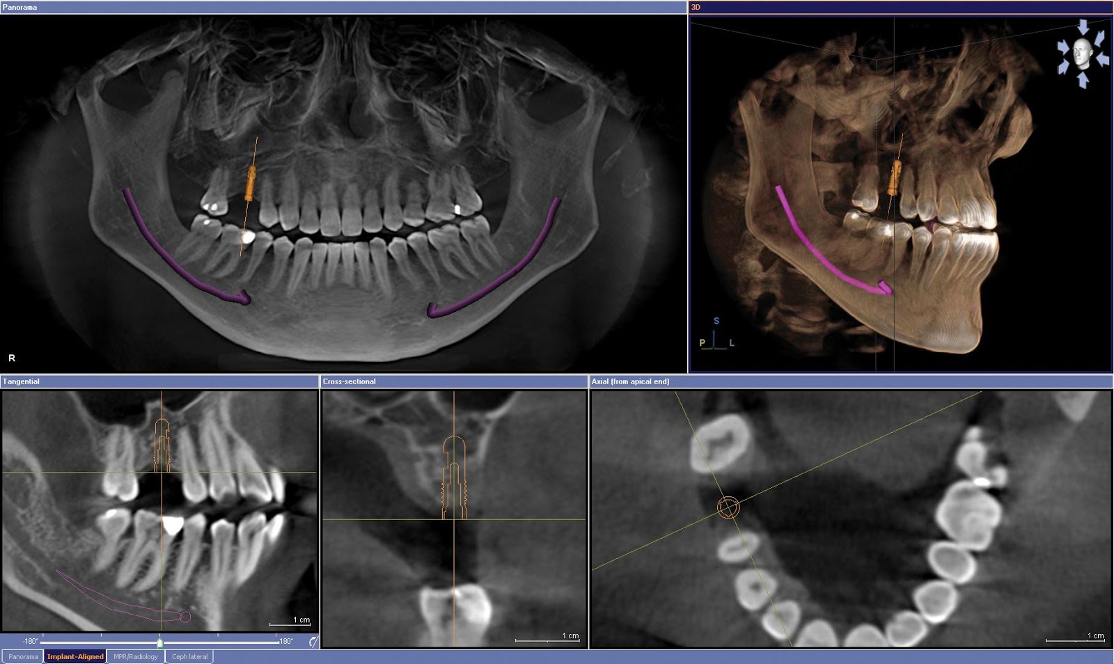 Blog de Cirugía Maxilofacial y Ortognática en Barcelona: Planificación ...