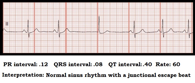 ECG Rhythm Strip Quiz 101: Interval measurements
