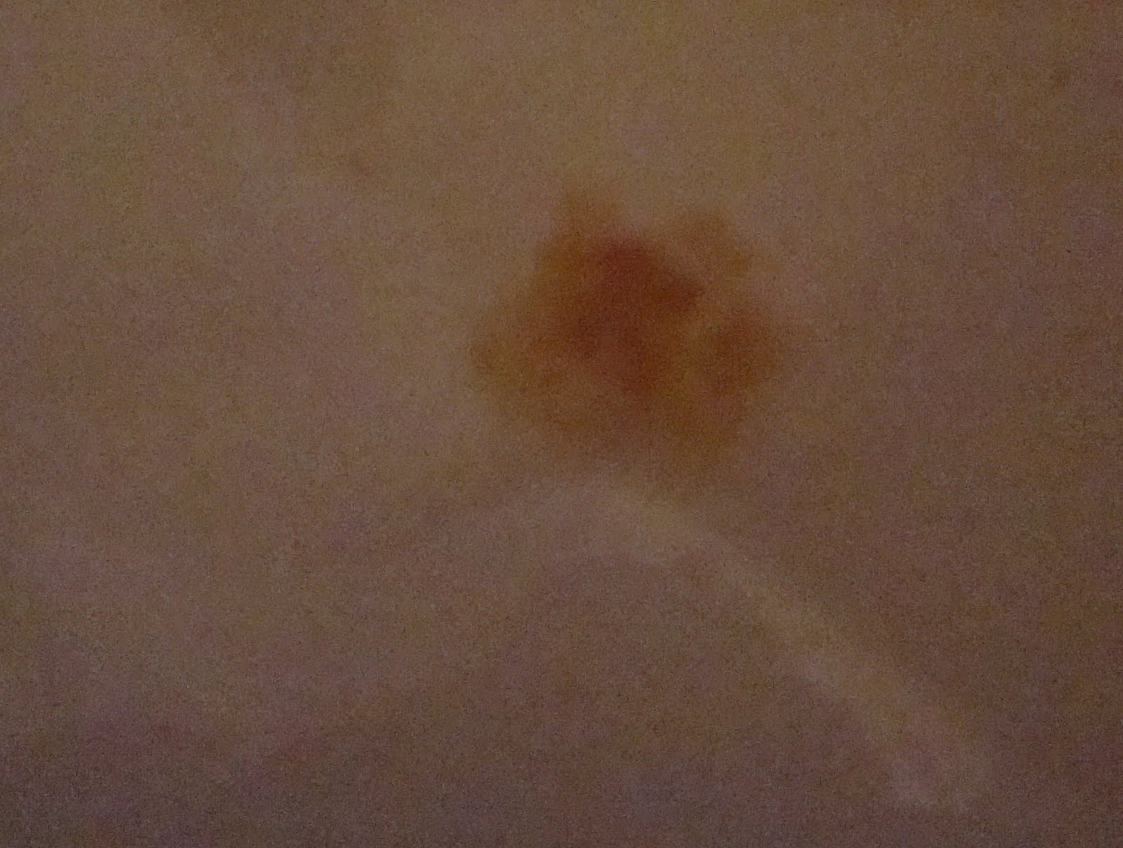 My Journey With Candida Blog : Pictures Of Candida ~ What Does Candida ...