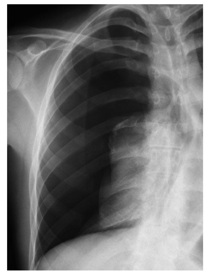 EMERGENCIA23RD,SRL: TRAUMA DE TORAX