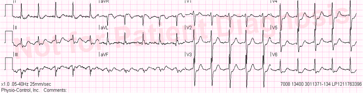Dr. Smith's ECG Blog: December 2014