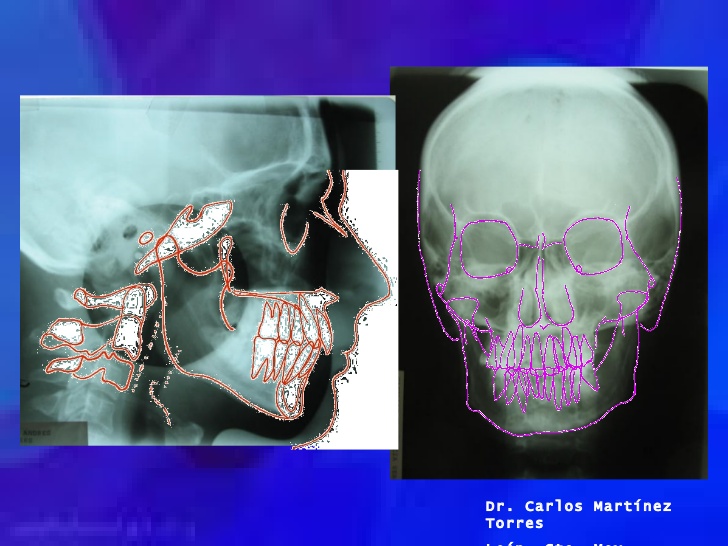 CEFALOGRAMA DE RICKETTS