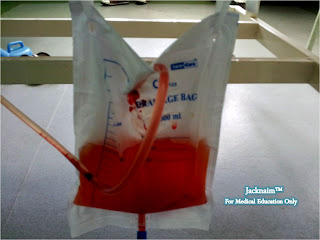 My Medical Notes: Image of The Day 9: Traumatic Haematuria