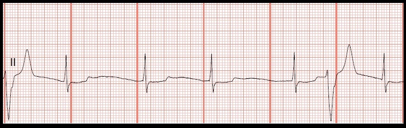 Practice EKG Rhythm Strips 179
