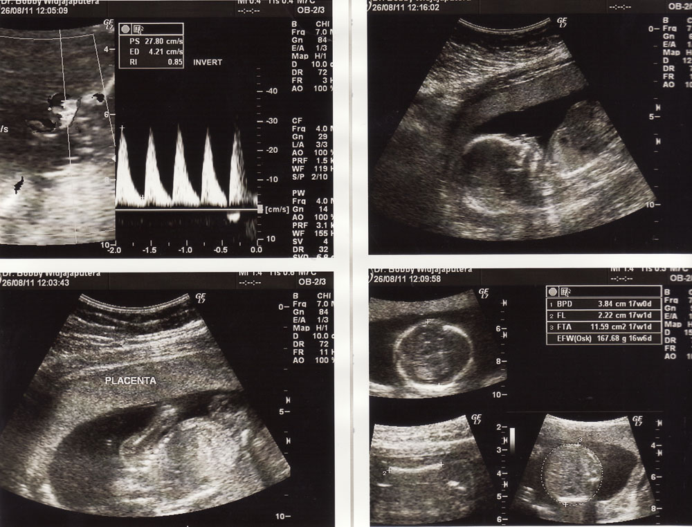 uniquely evita ヾ(´^,^)ノ♥: 17 Weeks Pregnant : 3D Ultrasound