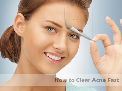 How to Clear Acne Fast and Naturally | Hormonal Acne Tips