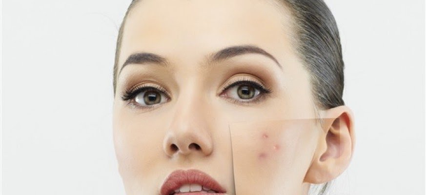 Kako se rijesiti bubuljica na prirodan nacin