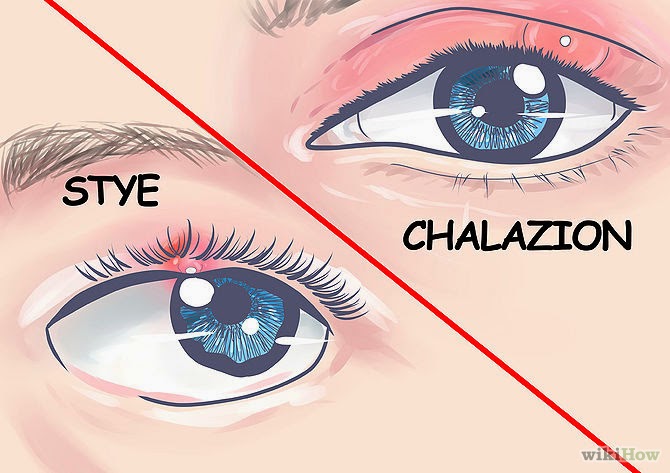 Dr Sherazi: Stye
