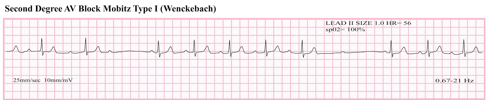 ECG Educator Blog : Heart Blocks