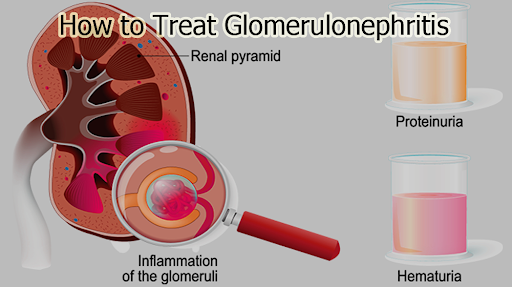 How to Treat Glomerulonephritis