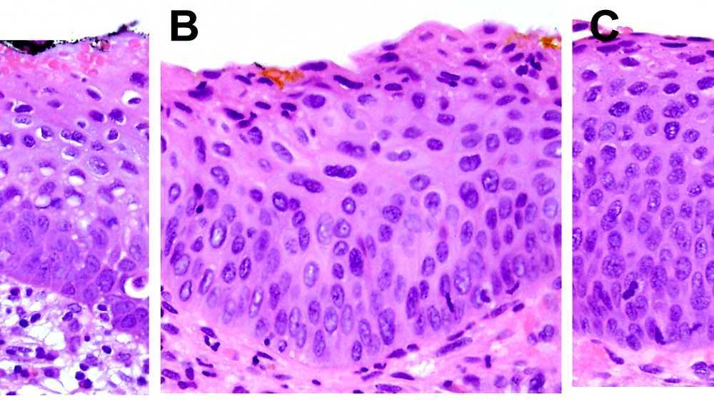 Cervical intraepithelial neoplasia